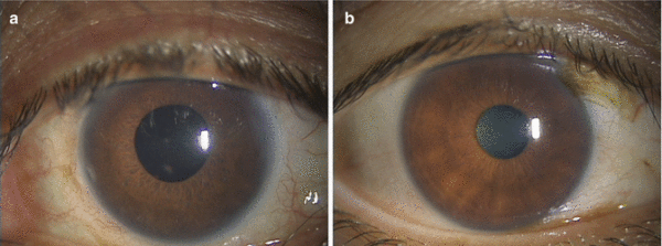 Posner-Schlossman症候群（ポスナーシュロスマン症候群） | オンライン眼科
