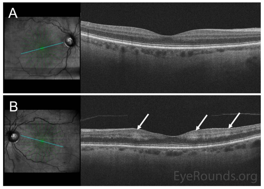 Paracentral acute middle maculopathy（PAMM） | オンライン眼科